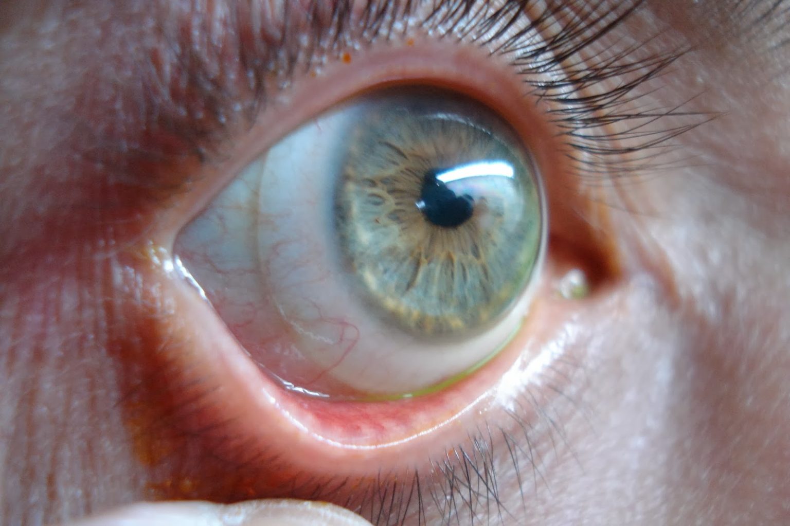 Queratocono, qué es, causa y tratamiento - Consejo al Día